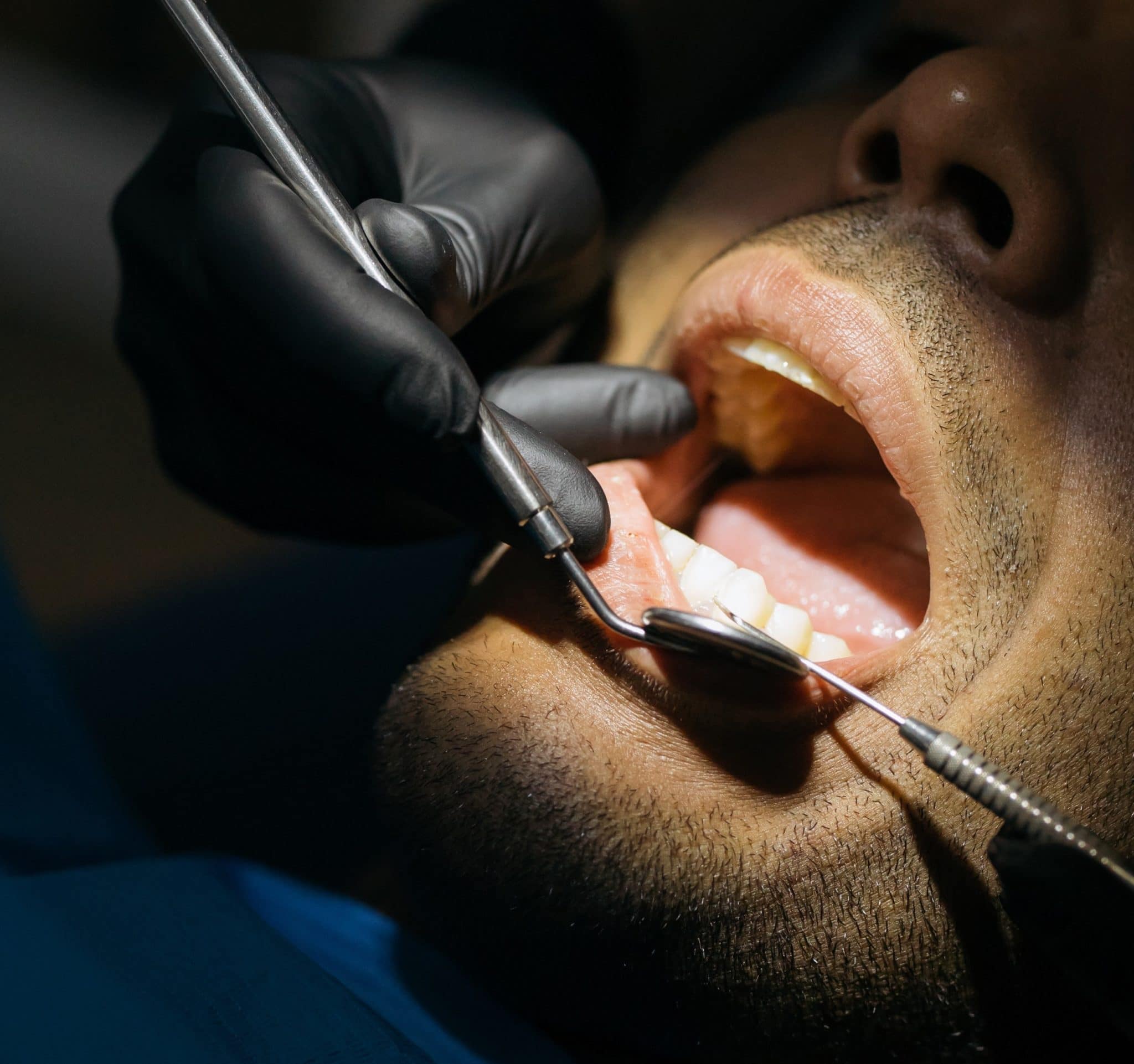 My tooth looks black under my crown | Pecan Park Dental